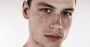 5 facts about freckles you didn’t know - Australian Skin Clinics