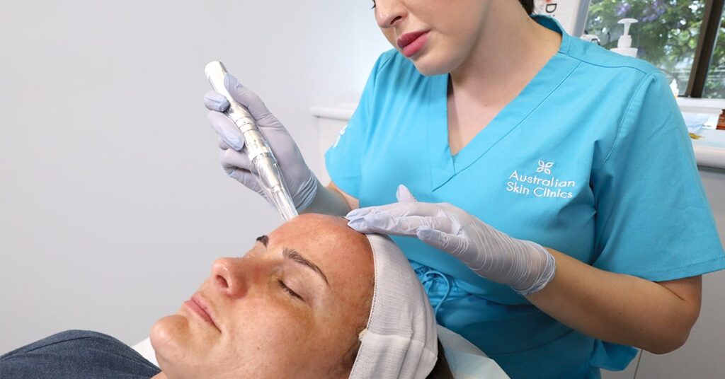Meso Needling vs Micro Needling - Australian Skin Clinics