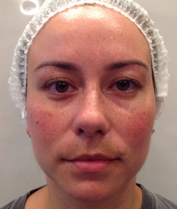 I tried the cosmelan peel: here is what to expect during your ...