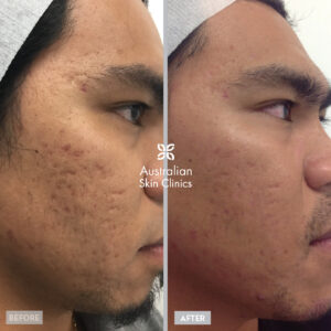 Lumixa™ - Australian Skin Clinics