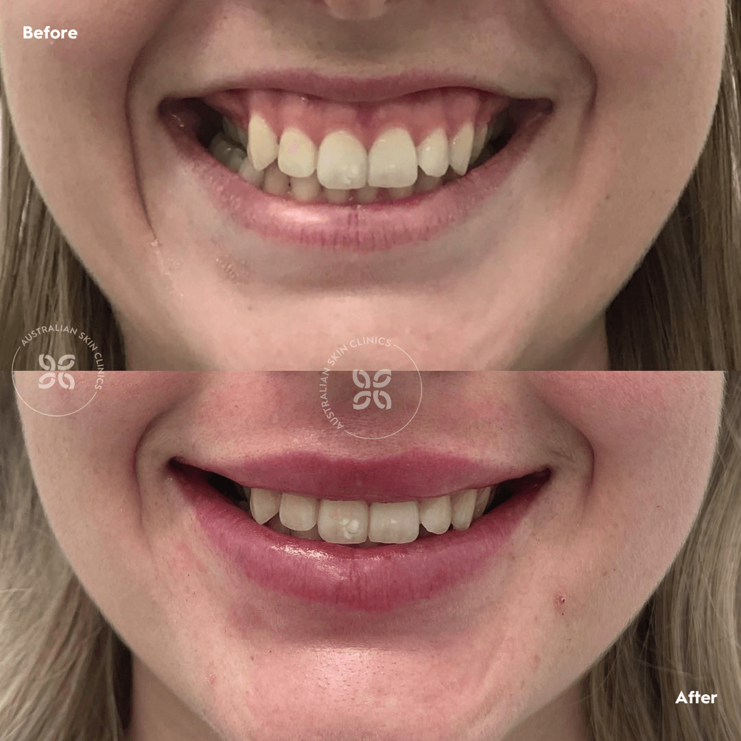 Correction - Australian Skin Clinics