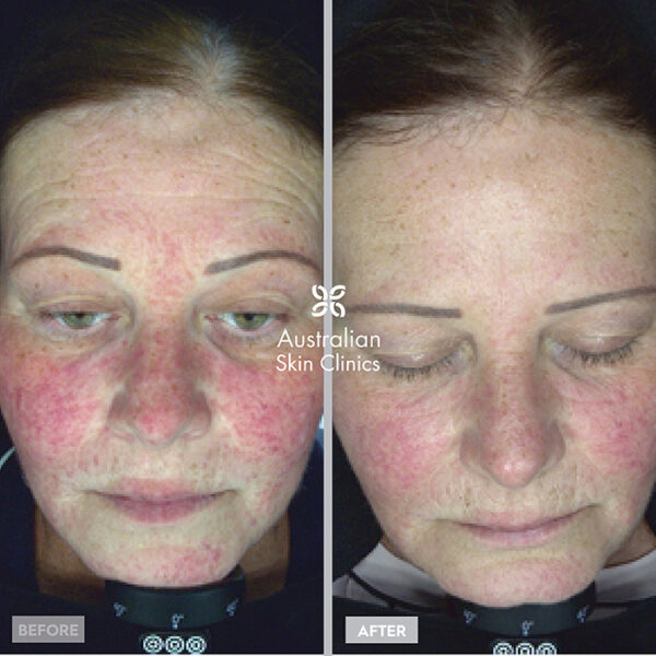 Lumixa™ - Australian Skin Clinics