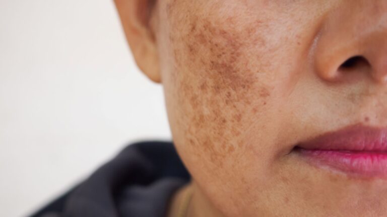 Pigmentation & Skin Tone | Australian Skin Clinics