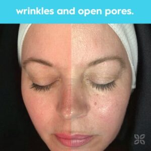 Observ Skin Analysis - Australian Skin Clinics