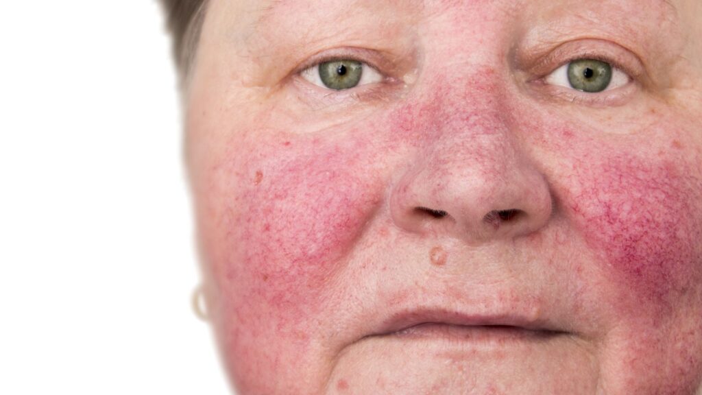 Diffuse Redness Skin Treatment. Australian Skin Clinics