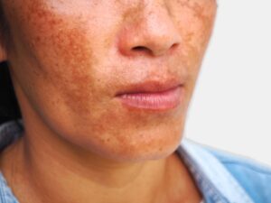 Pigmentation & Skin Tone | Australian Skin Clinics
