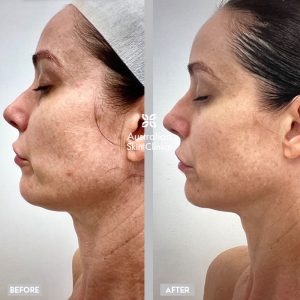 Sylfirm X Advanced RF Needling - Australian Skin Clinics