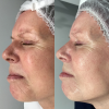 Renuva Advanced Resurfacing | Australian Skin Clinics