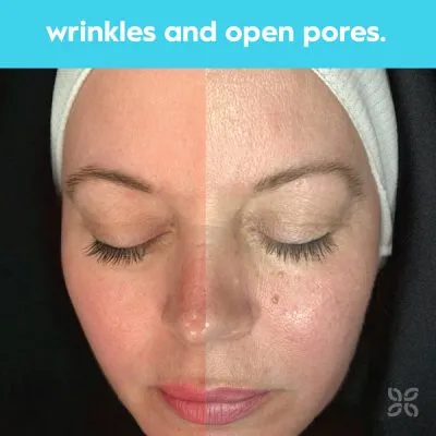 Observ Skin Analysis - Australian Skin Clinics