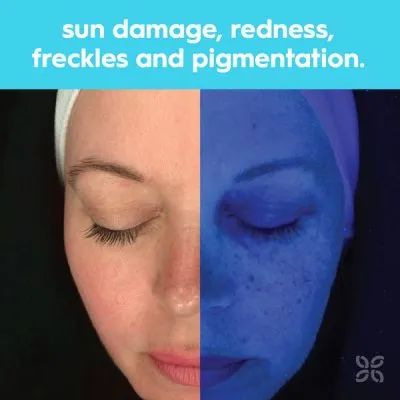 Observ Skin Analysis - Australian Skin Clinics