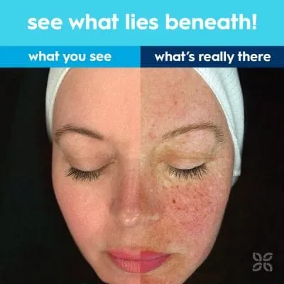 Observ Skin Analysis - Australian Skin Clinics